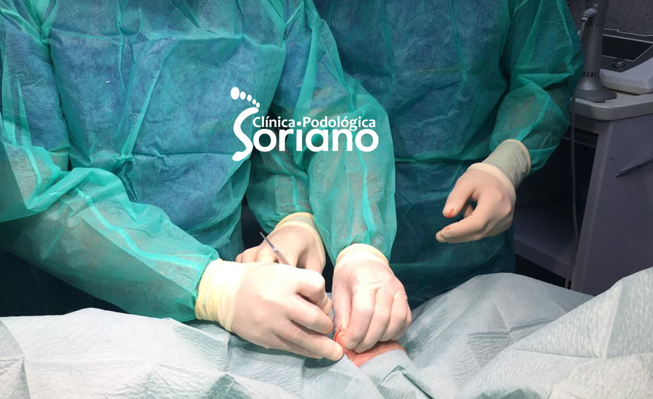 Cirugía percutánea de un heloma interdigital o Ojo de Gallo - Clínica ...