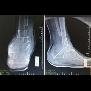 ¿Qué es el pie de Charcot? - Clínica Soriano